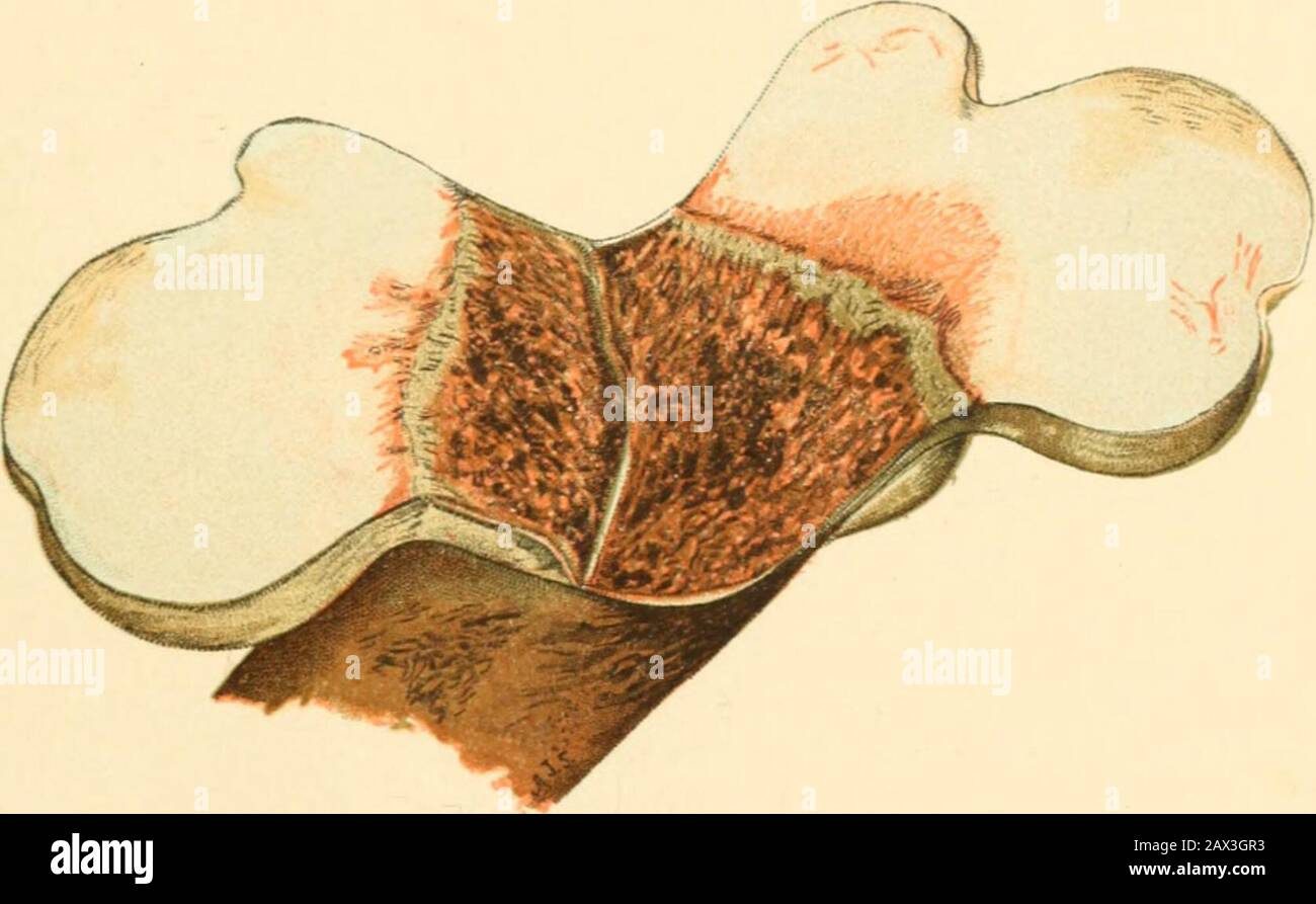 Gummatous syphilis hi-res stock photography and images - Alamy