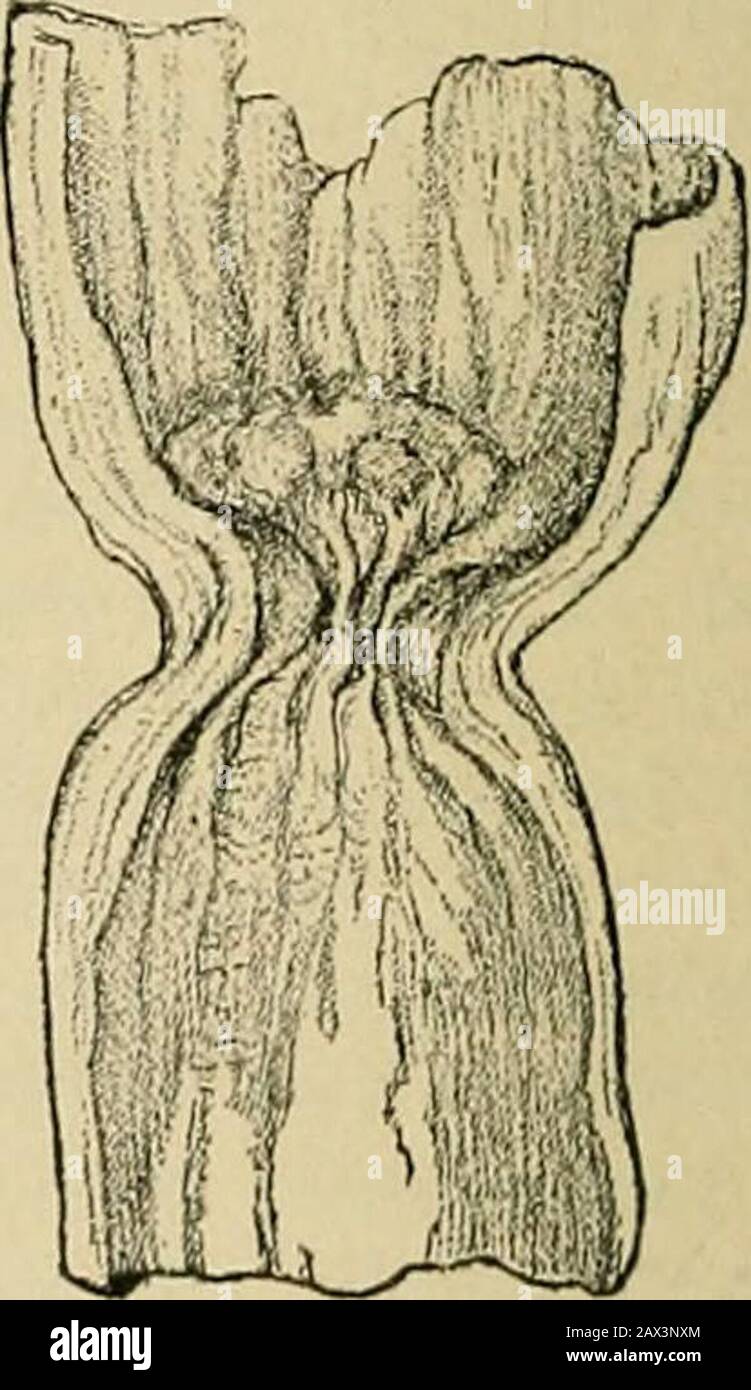 Surgery; its theory and practice . Fibrous strictre of oesophagus at ...