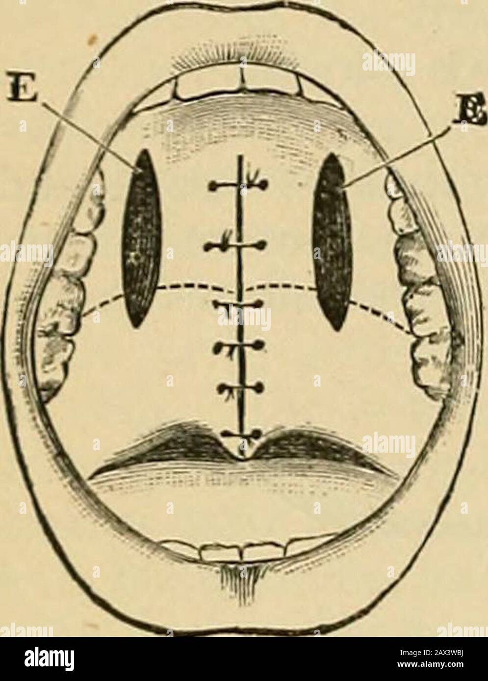 Hamular Process