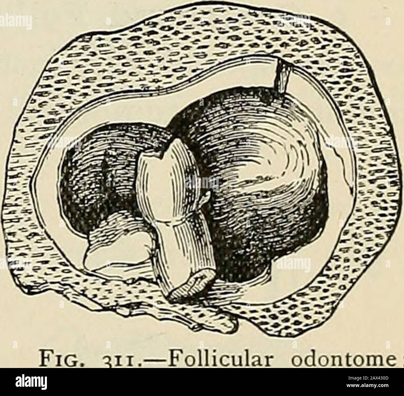 The pathology and surgical treatment of tumors . Fig. 310 ...
