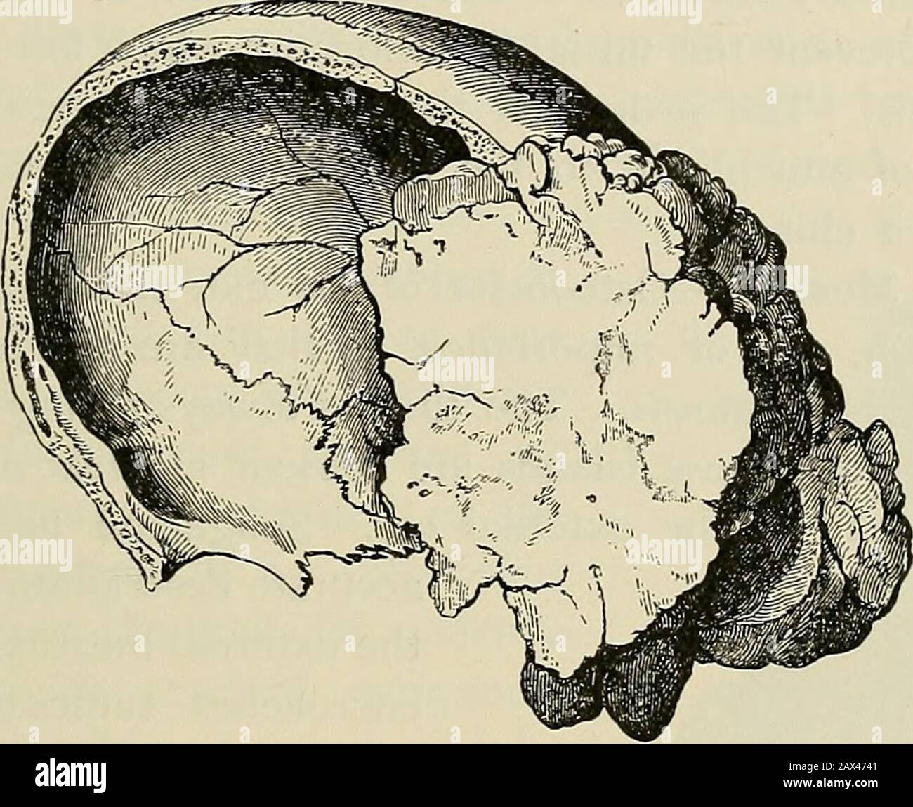 The pathology and surgical treatment of tumors . yer of cartilage often ...