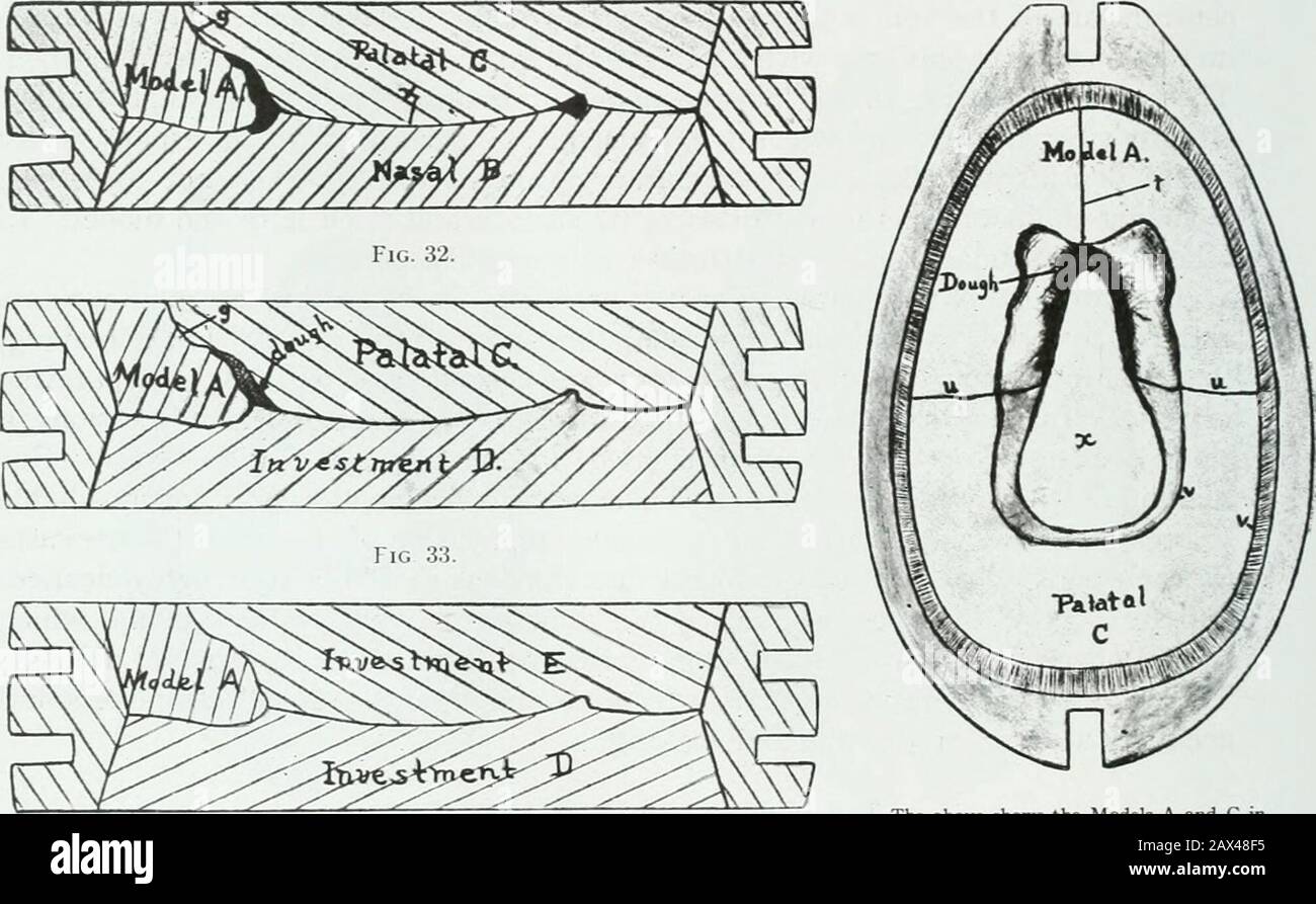 Palatal obturator hi-res stock photography and images - Alamy