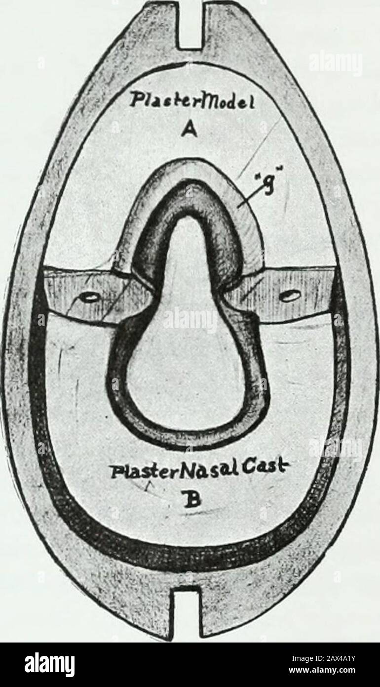 Palatal Obturator Hi Res Stock Photography And Images Alamy