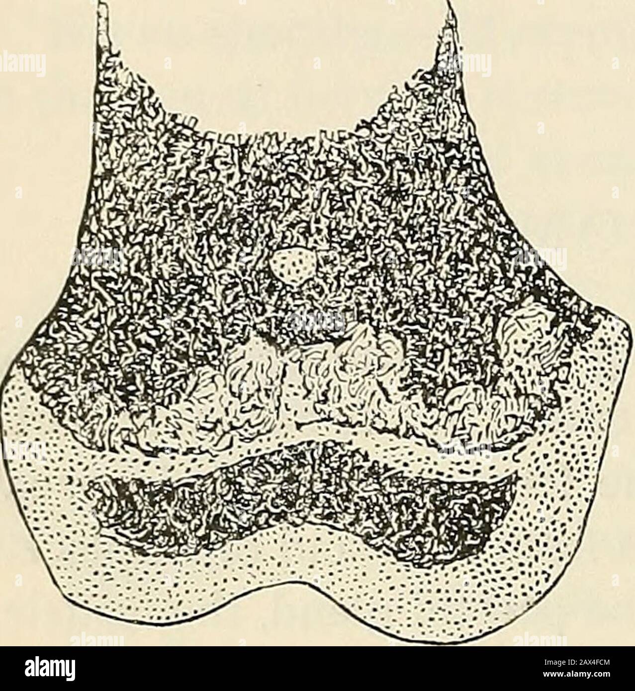 Adenoid tissue hi-res stock photography and images - Alamy