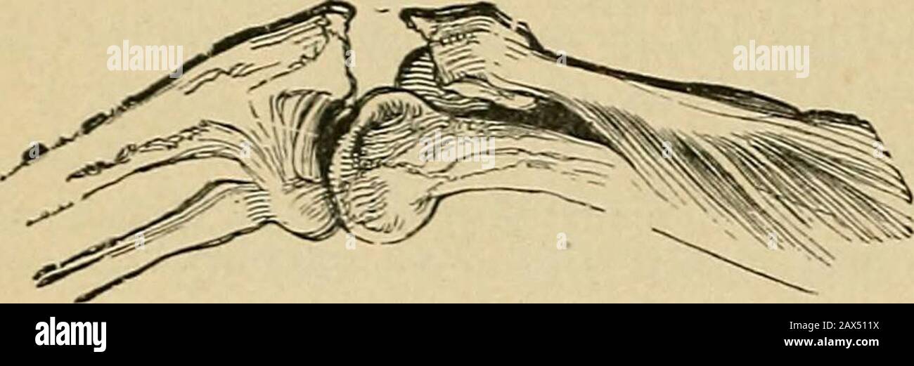 Fracture olecranon process of ulna hi-res stock photography and images ...