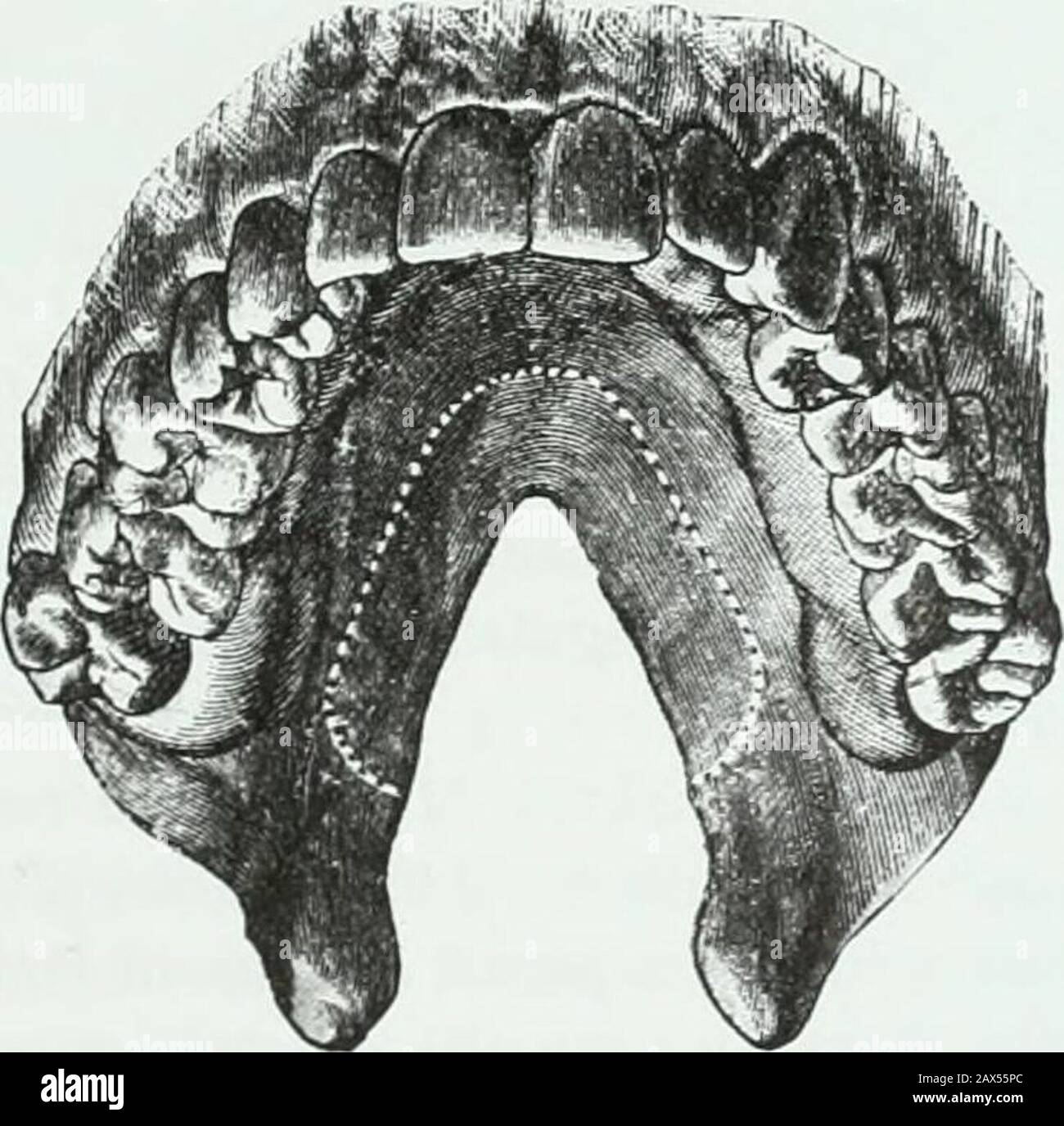 Cleft Palate Teeth