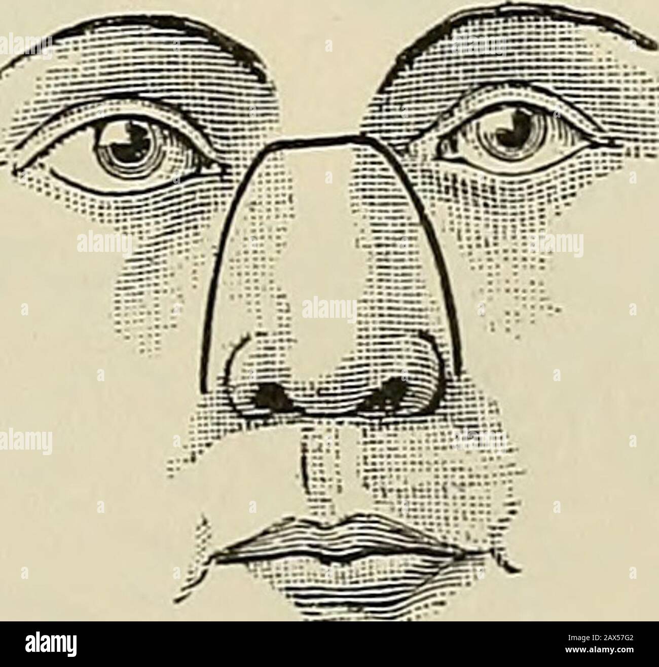 The pathology and surgical treatment of tumors . Fig. -Temporary ...