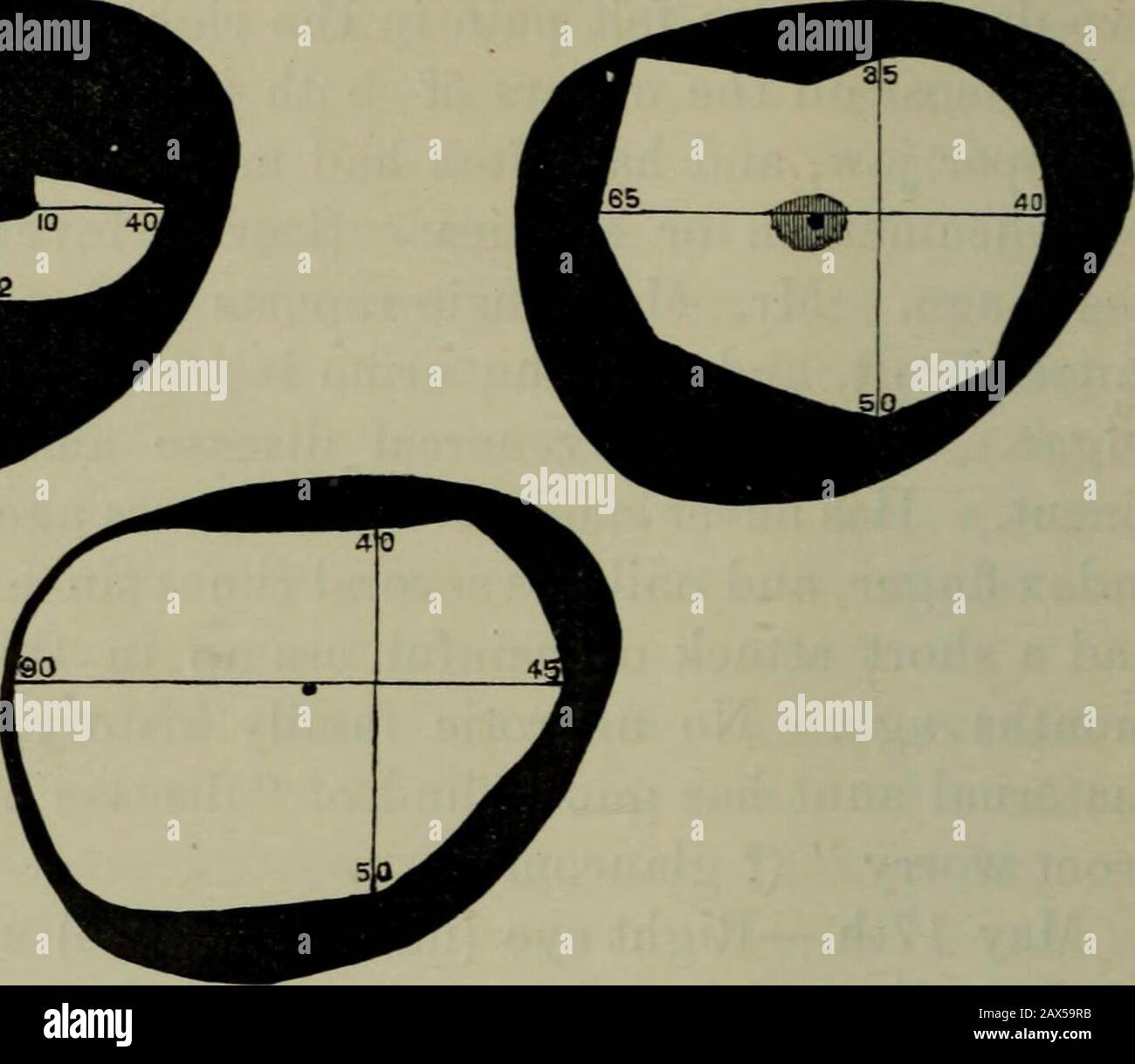 Transactions . Field of vision (right eye).—Case ll.|Fig. 1, May 17th ...