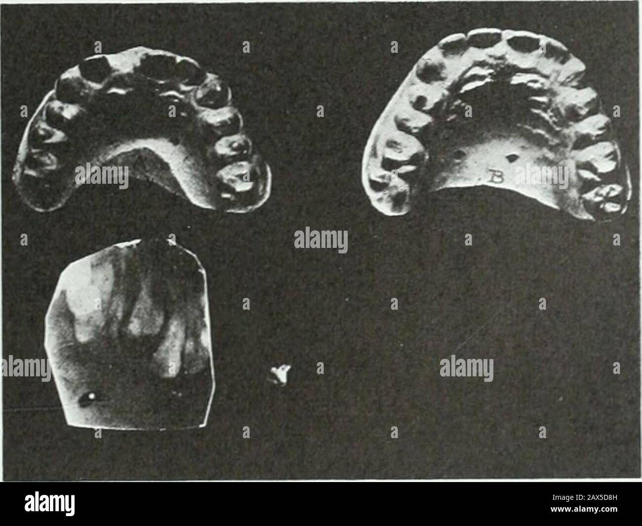 Cleft palate before and after hi-res stock photography and images - Alamy