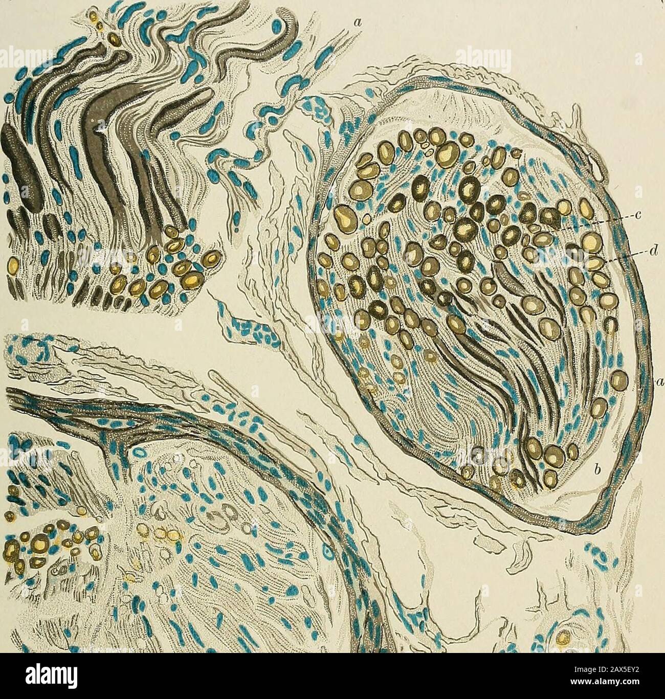 Fibromata hi-res stock photography and images - Alamy