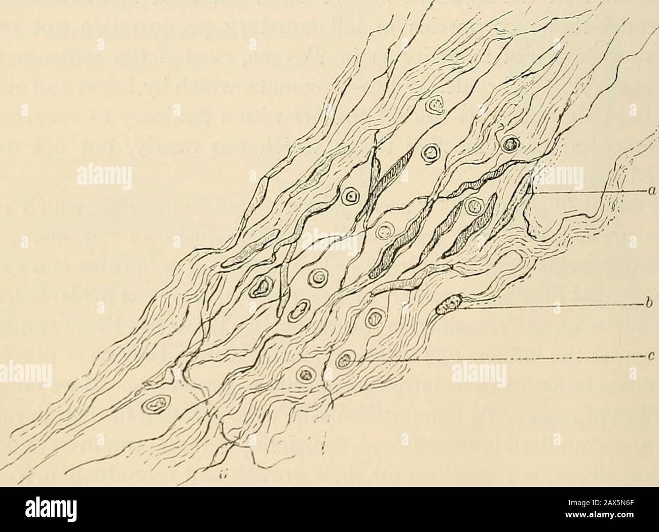 The pathology and surgical treatment of tumors . Fig. 260.—Hard fibroma ...
