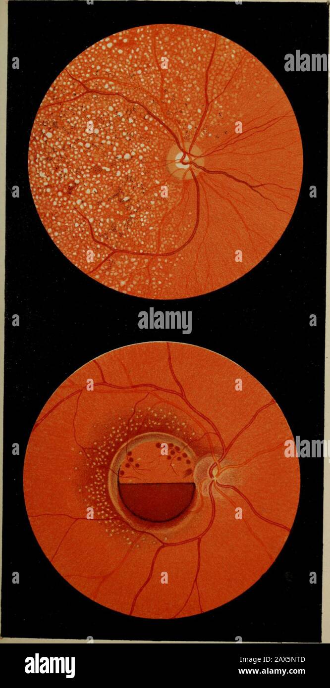 Scotoma hi-res stock photography and images - Alamy
