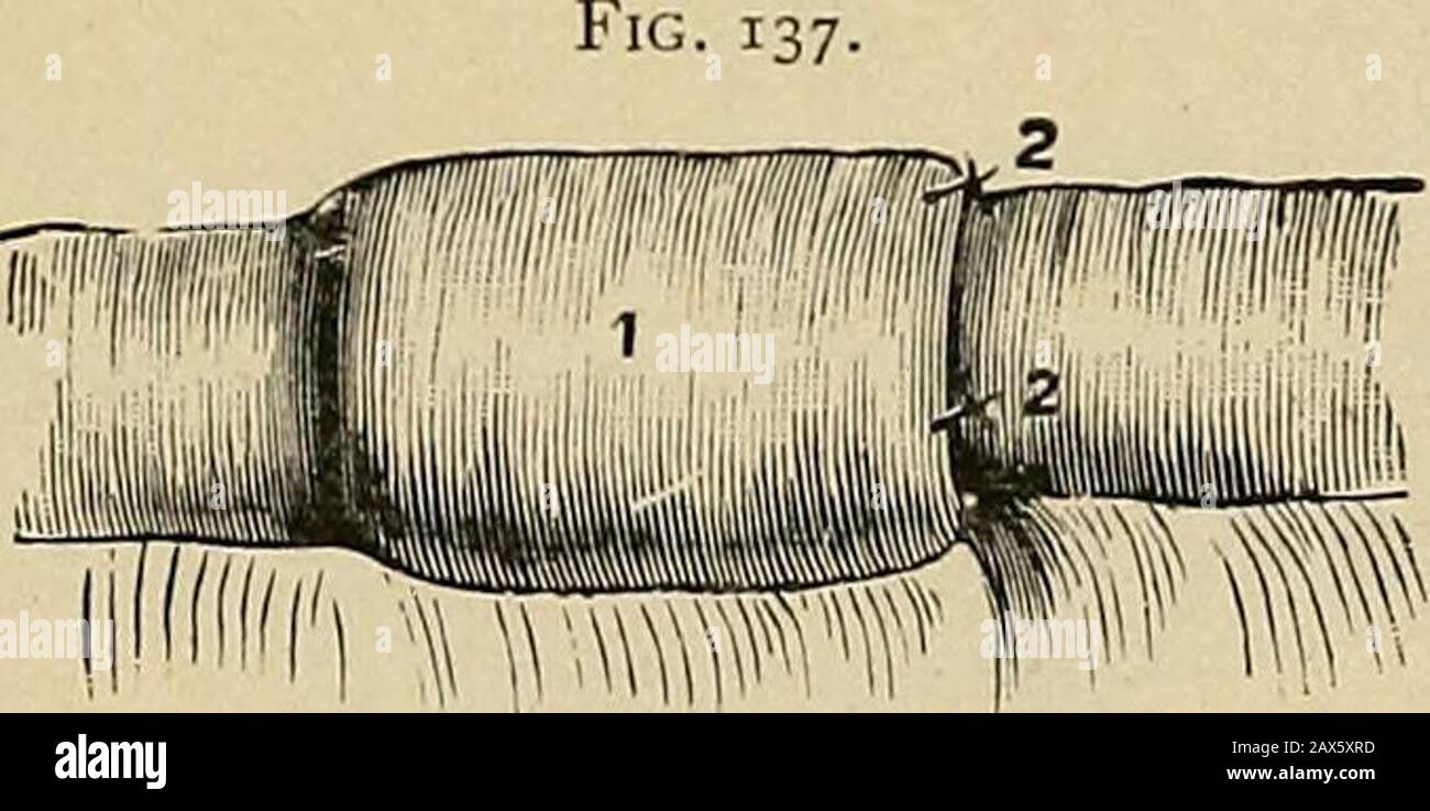 Anastomosis distal hi-res stock photography and images - Alamy
