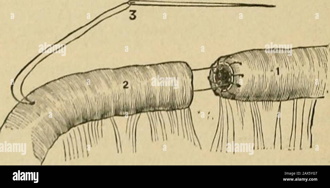 Perforated bowel hi-res stock photography and images - Alamy