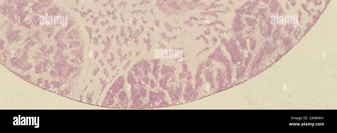 The pathology and surgical treatment of tumors . Fig. 242.—Beginning ...