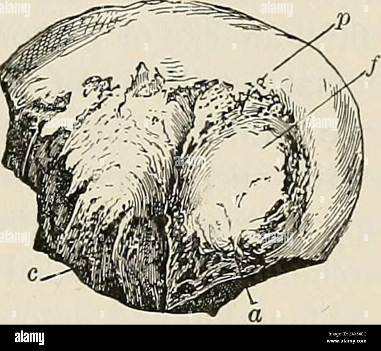 The pathology and surgical treatment of tumors . Fig. 242.—Beginning ...