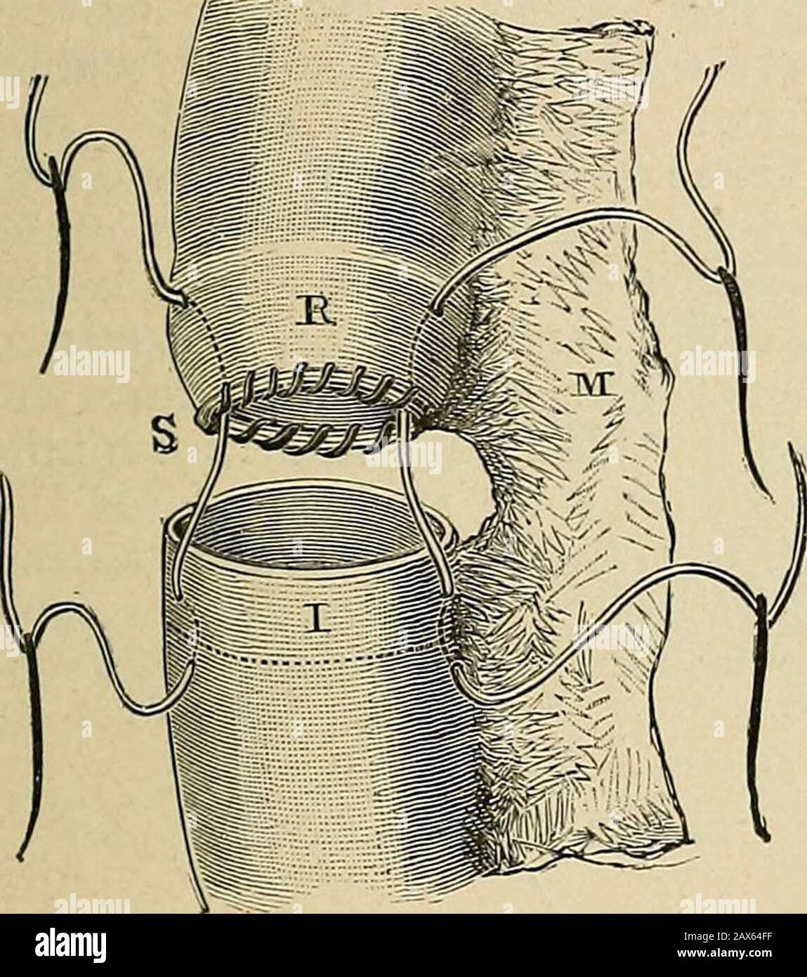 Anastomosis intestinal hi-res stock photography and images - Alamy