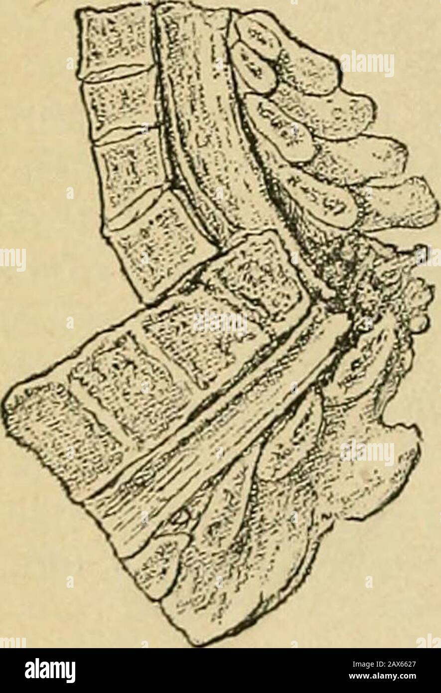 Dislocated vertebrae hi-res stock photography and images - Alamy