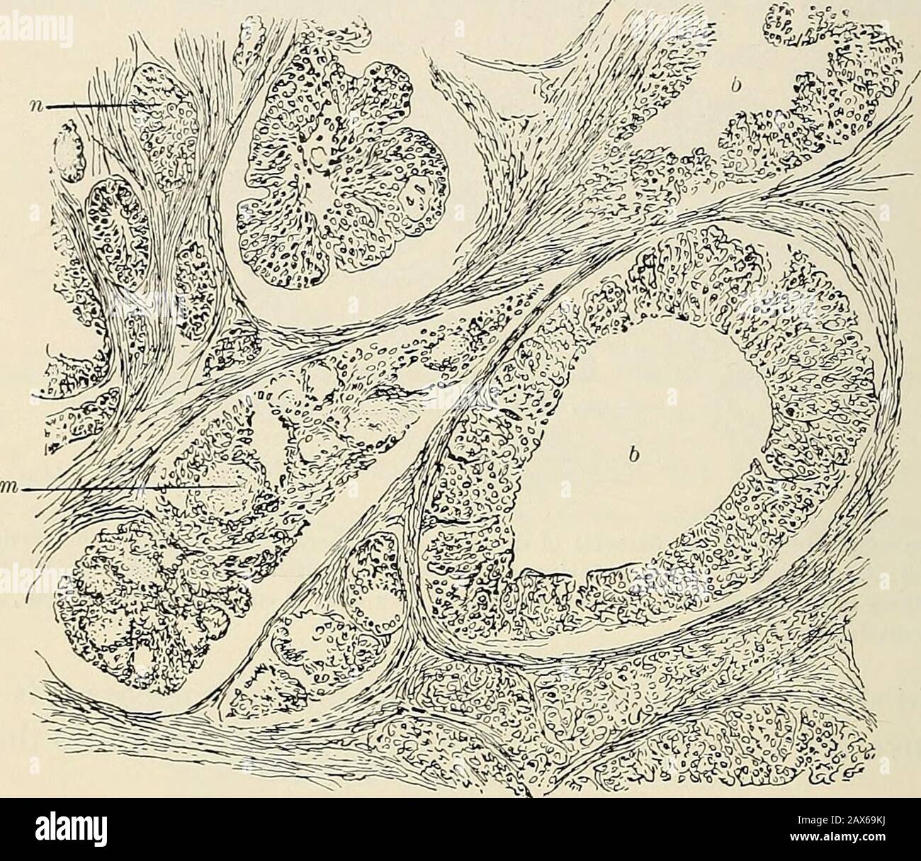 The pathology and surgical treatment of tumors . Fig. 23s.—Carcinoma of ...