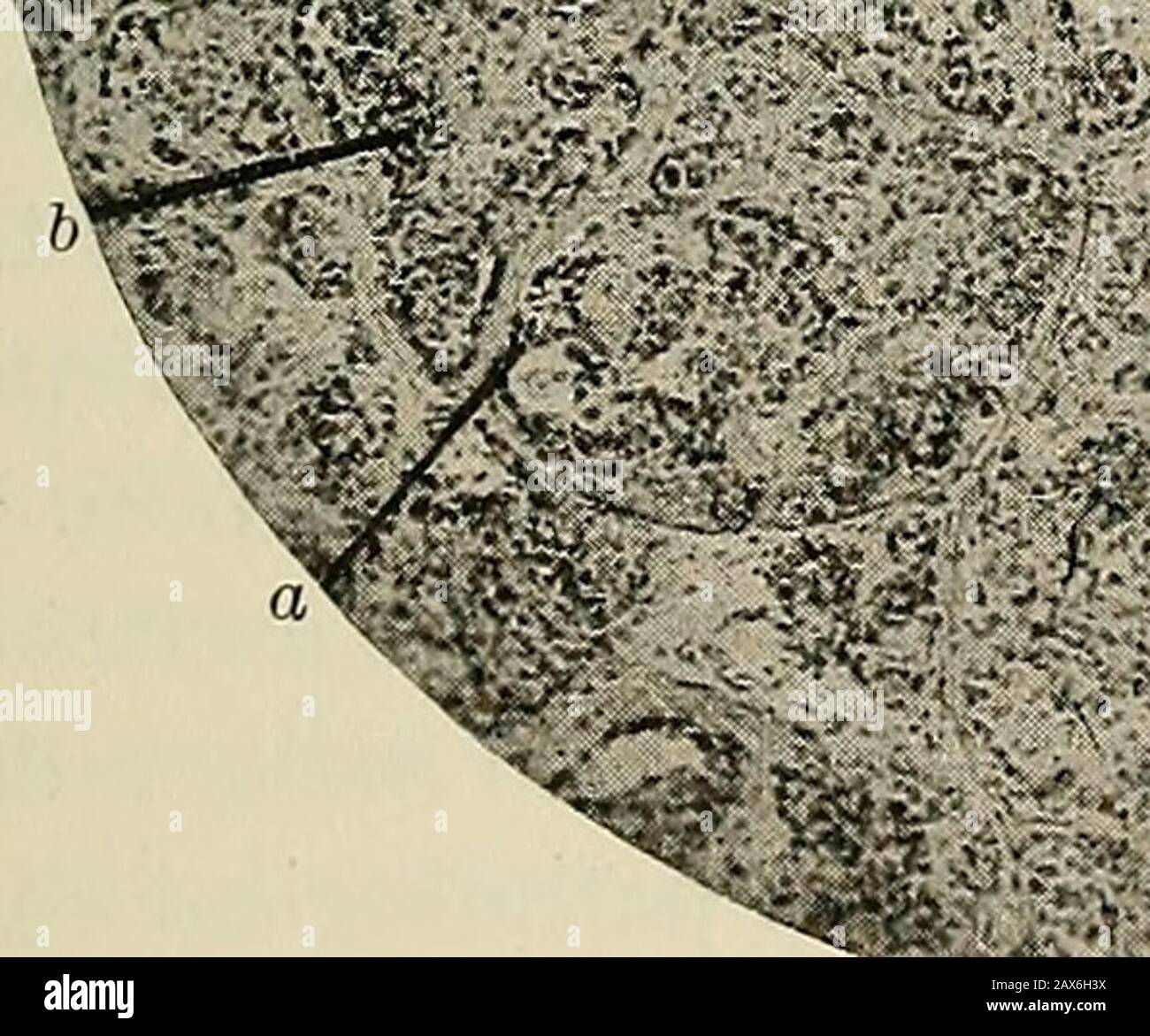 Colloid cysts hi-res stock photography and images - Alamy