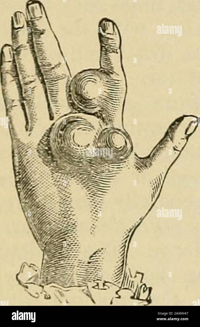 Enucleated hi-res stock photography and images - Alamy