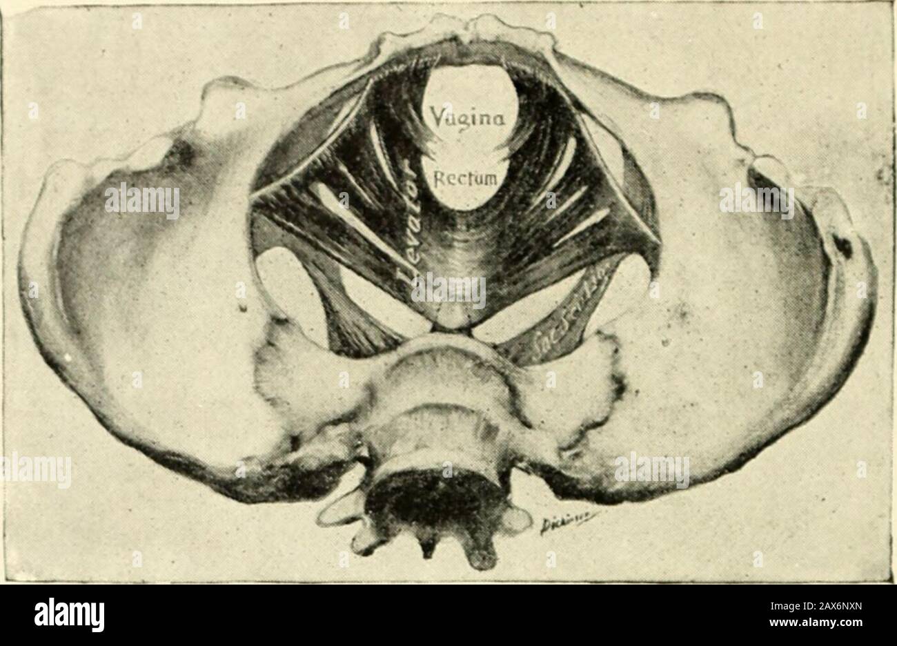 A textbook of obstetrics . g. 9.—The pelvic canal encroached upon by ...