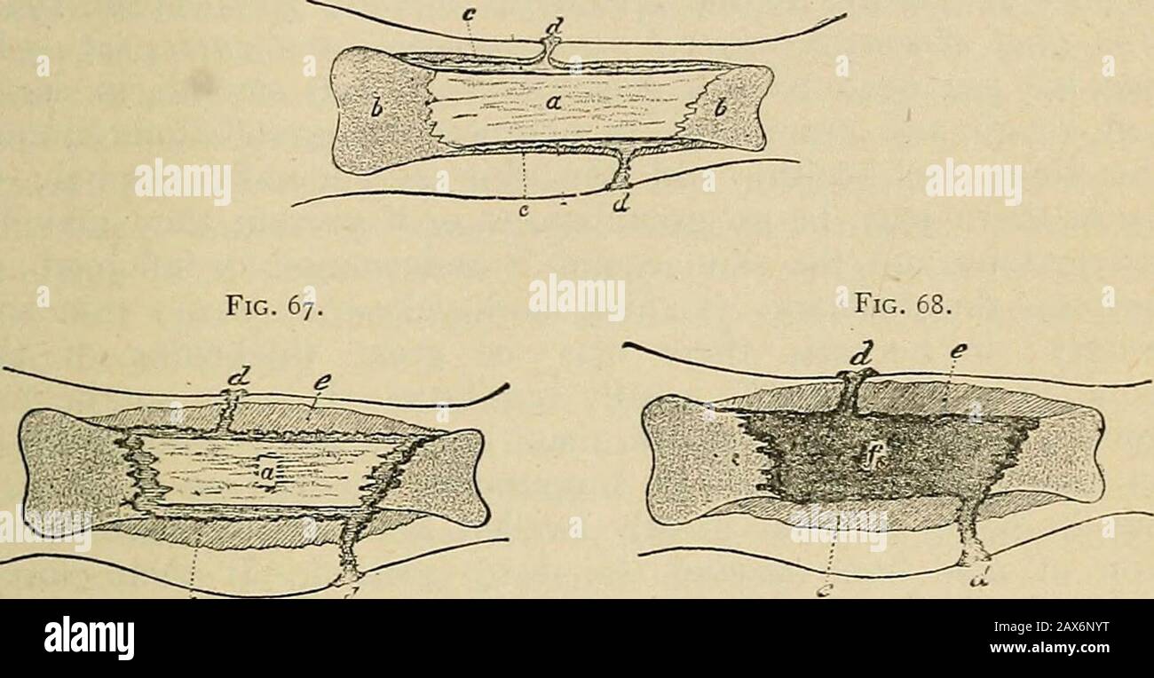 Surgery; its theory and practice . pus in a cavitylined with ...
