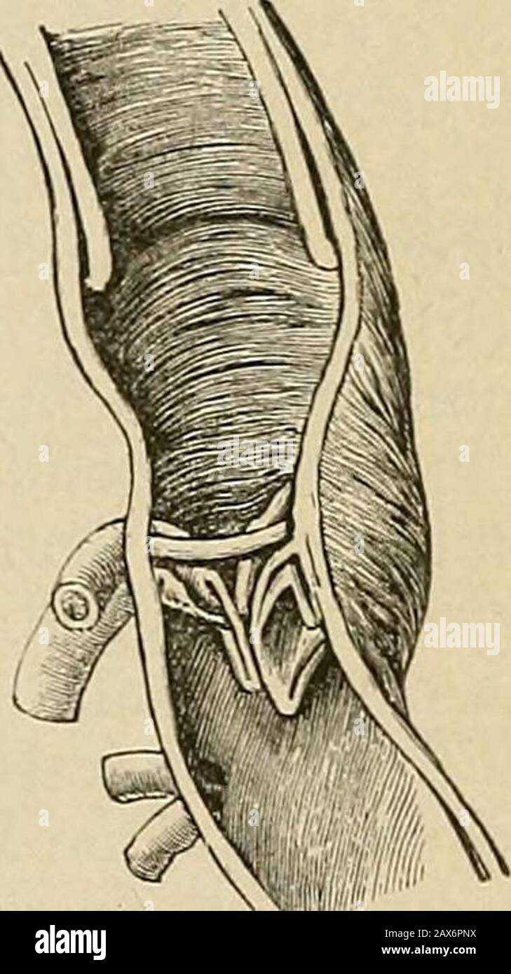 Surgery; its theory and practice . the extravasatedblood on the ...