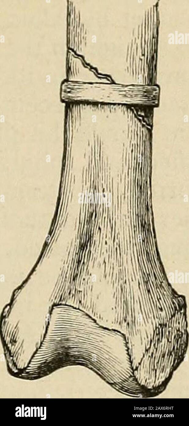 Un united fractures hi-res stock photography and images - Alamy