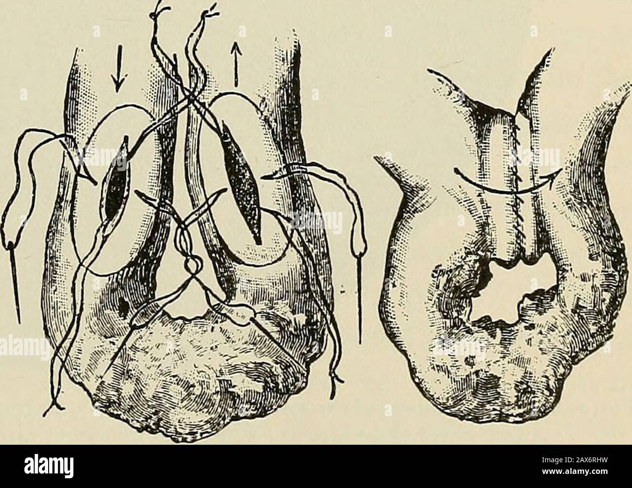 The pathology and surgical treatment of tumors . cified bone-plates ...