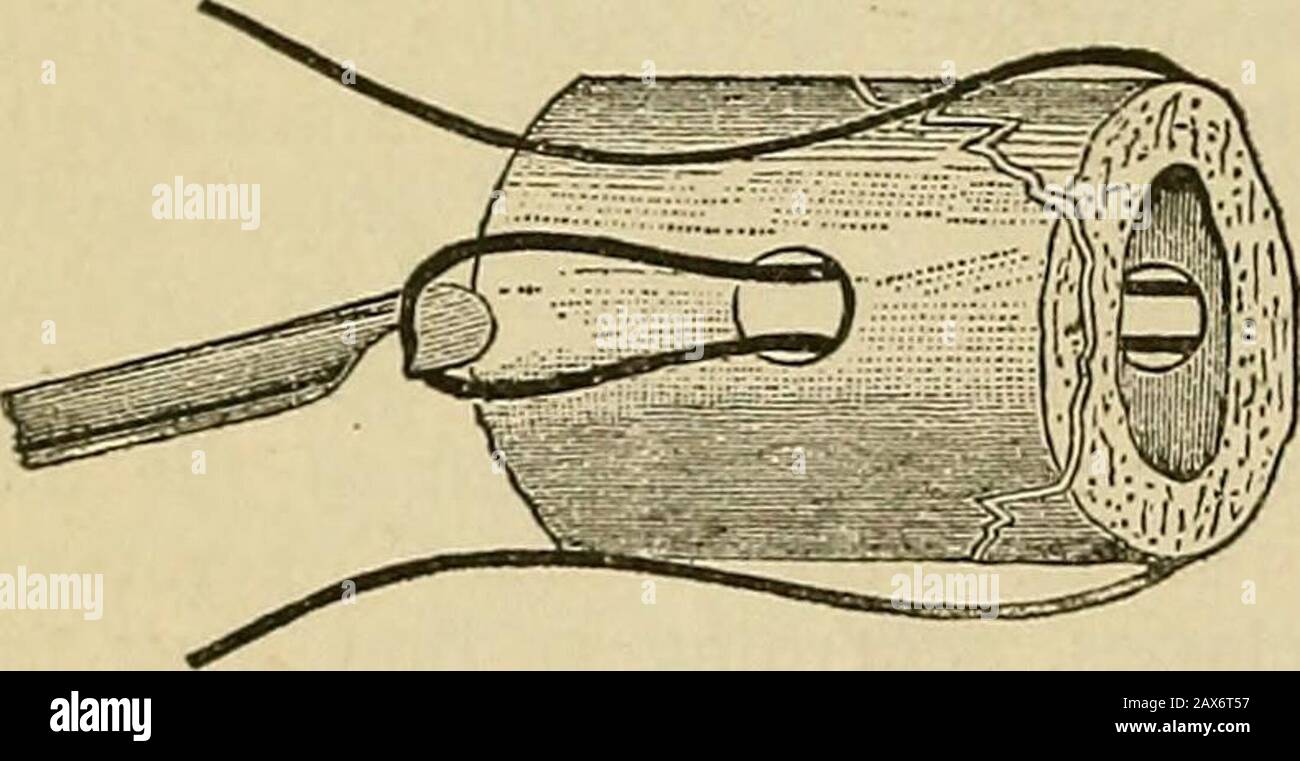 Surgery; its theory and practice . FlG. 49. Fig. 50 Stock Photo - Alamy