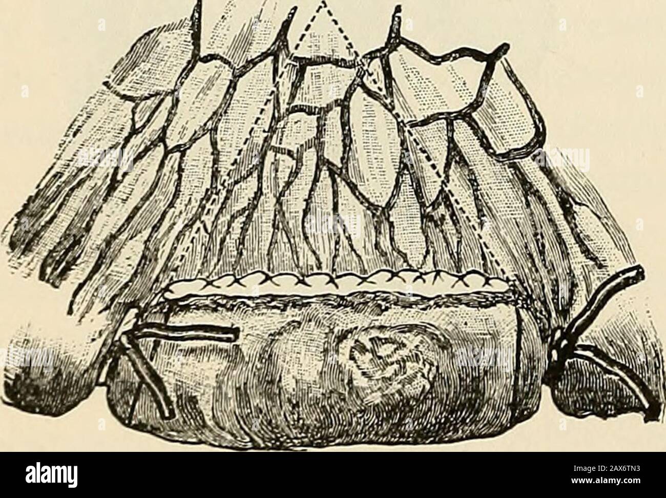 The pathology and surgical treatment of tumors . and the bowel is ...