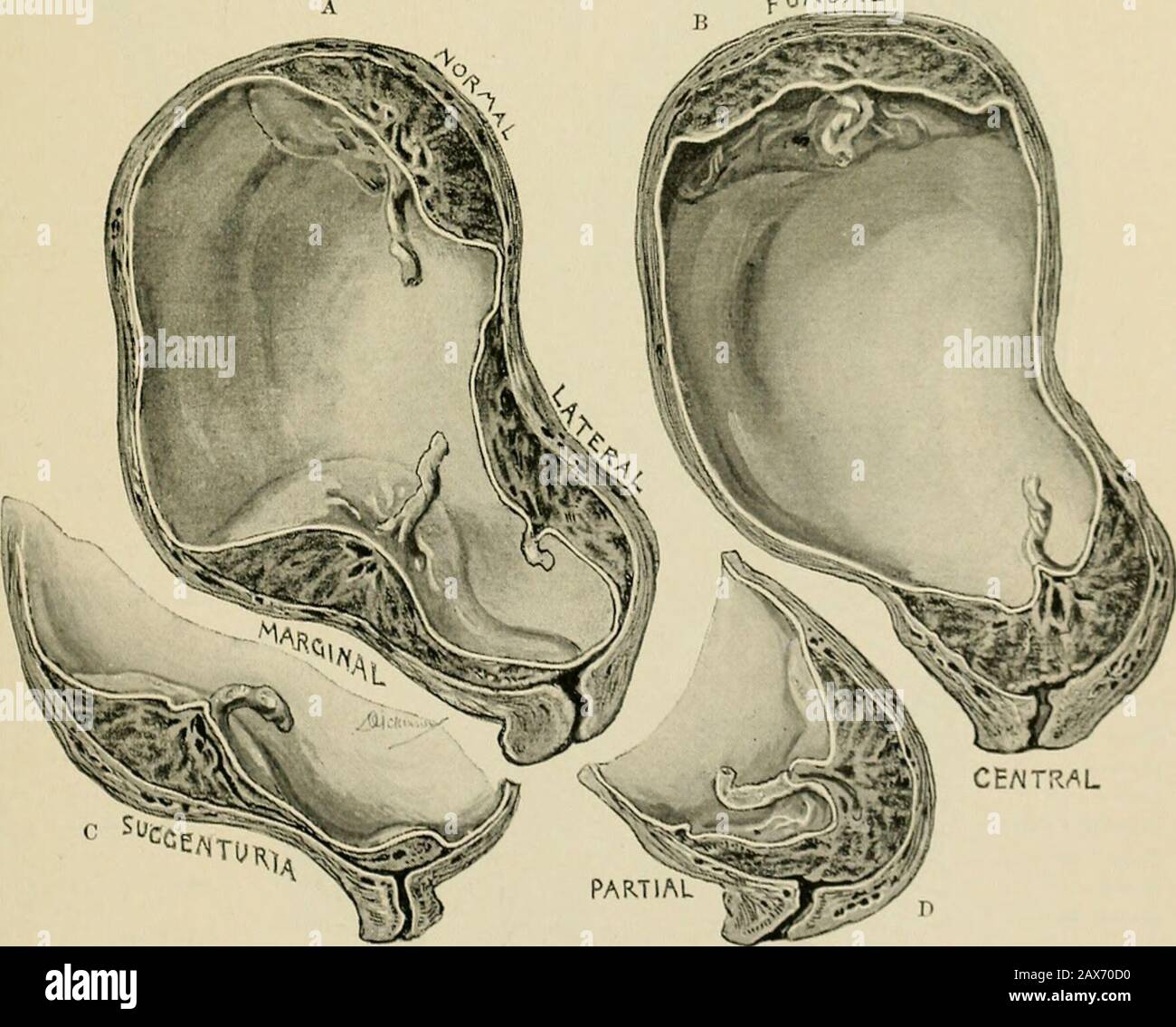 Placenta praevia hi-res stock photography and images - Alamy
