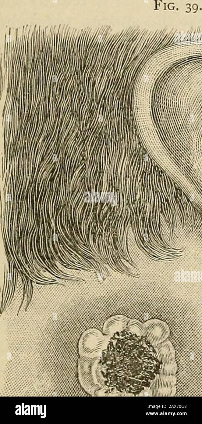 Malignant pustule hi-res stock photography and images - Alamy