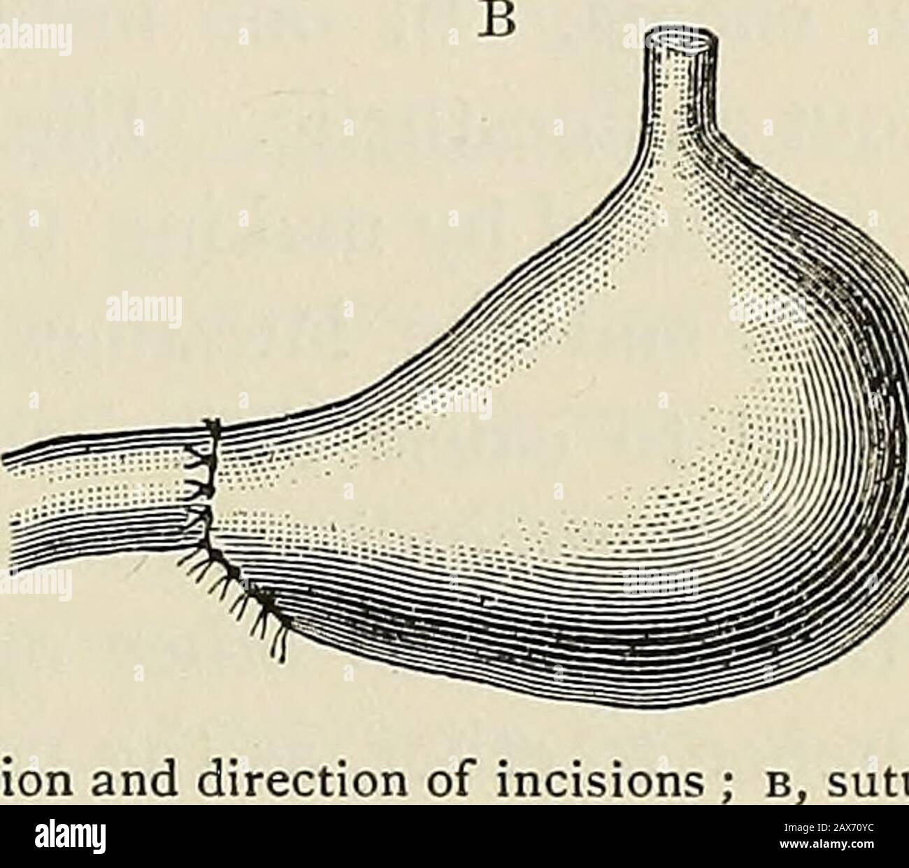 The pathology and surgical treatment of tumors . Fig. 206.—Resection of ...