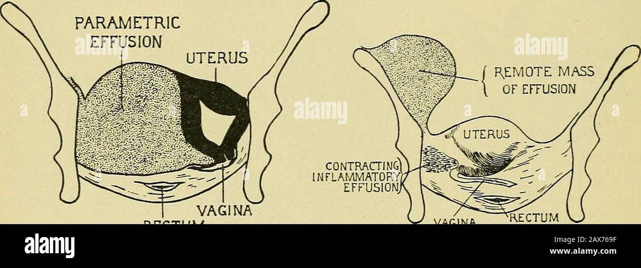 Formation of an abscess hi-res stock photography and images - Alamy