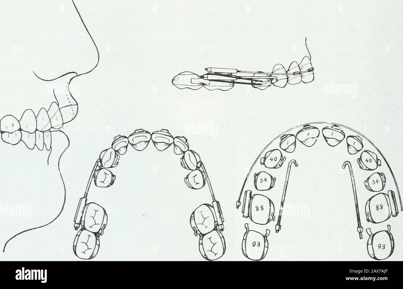 Labial wire hi-res stock photography and images - Alamy