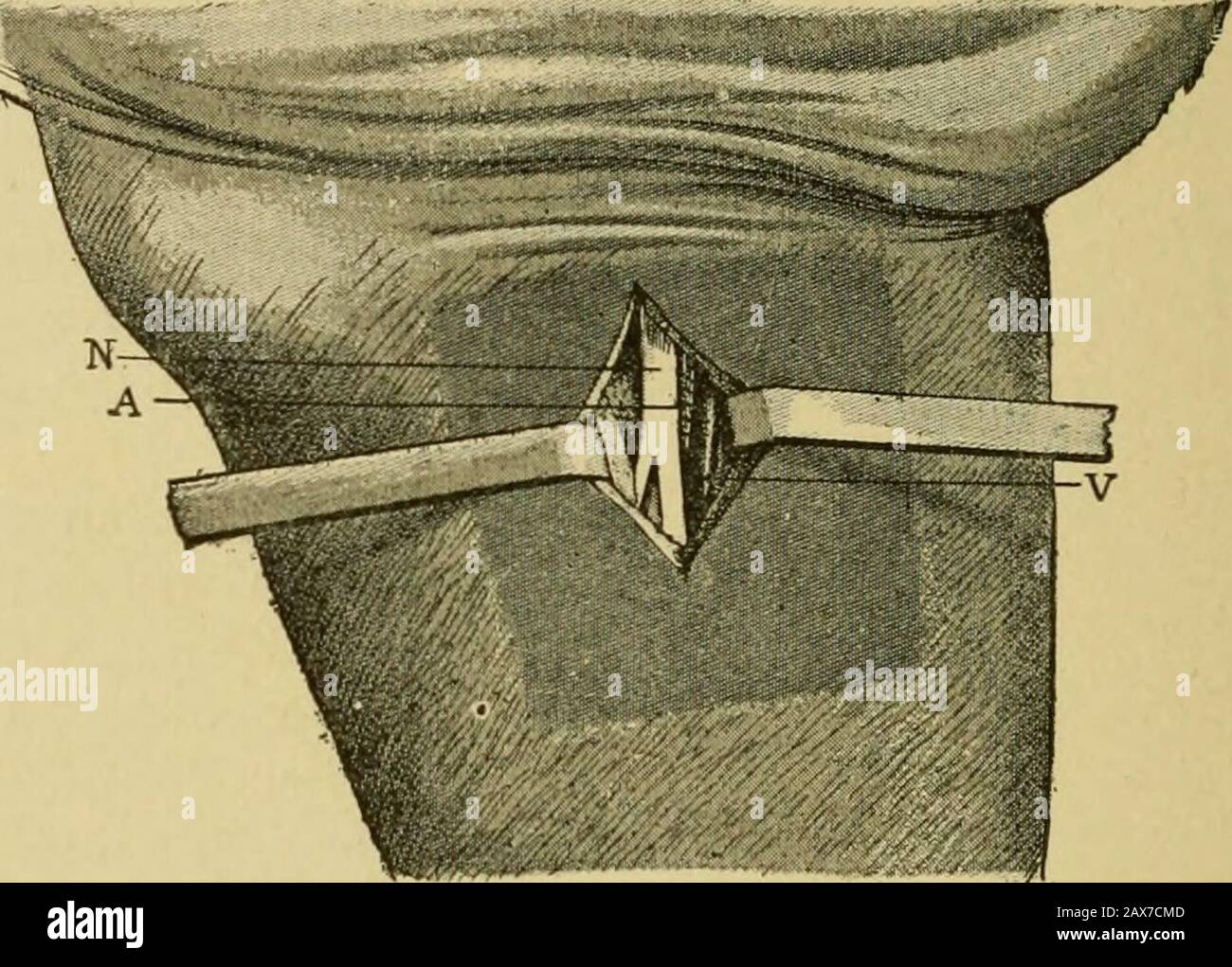 Exercises in equine surgery . gle of the wound make a short incision of ...