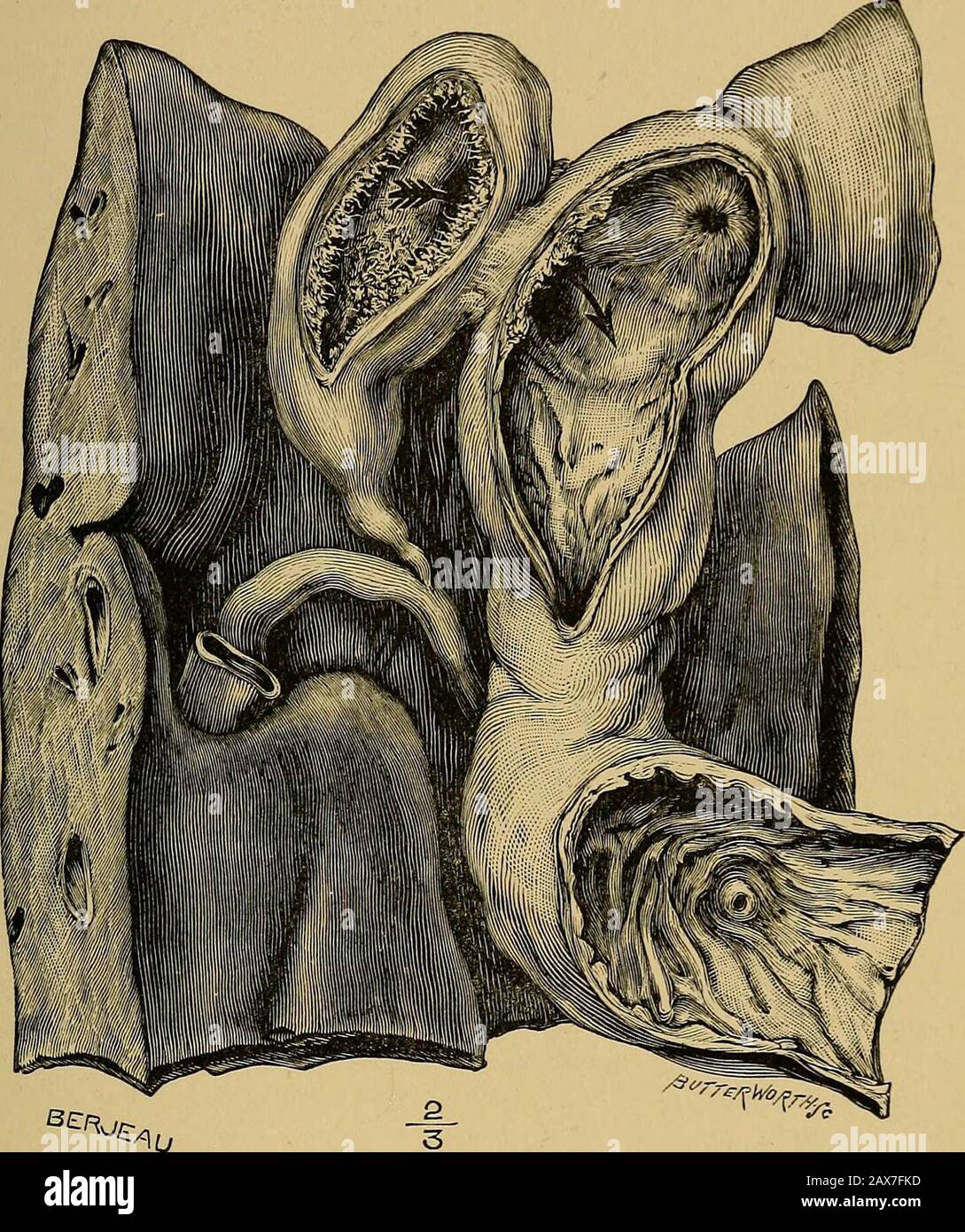 Ileus hi-res stock photography and images - Alamy