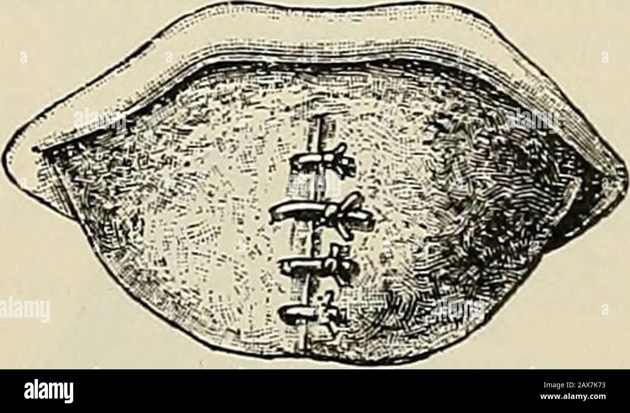 External incision hi-res stock photography and images - Alamy