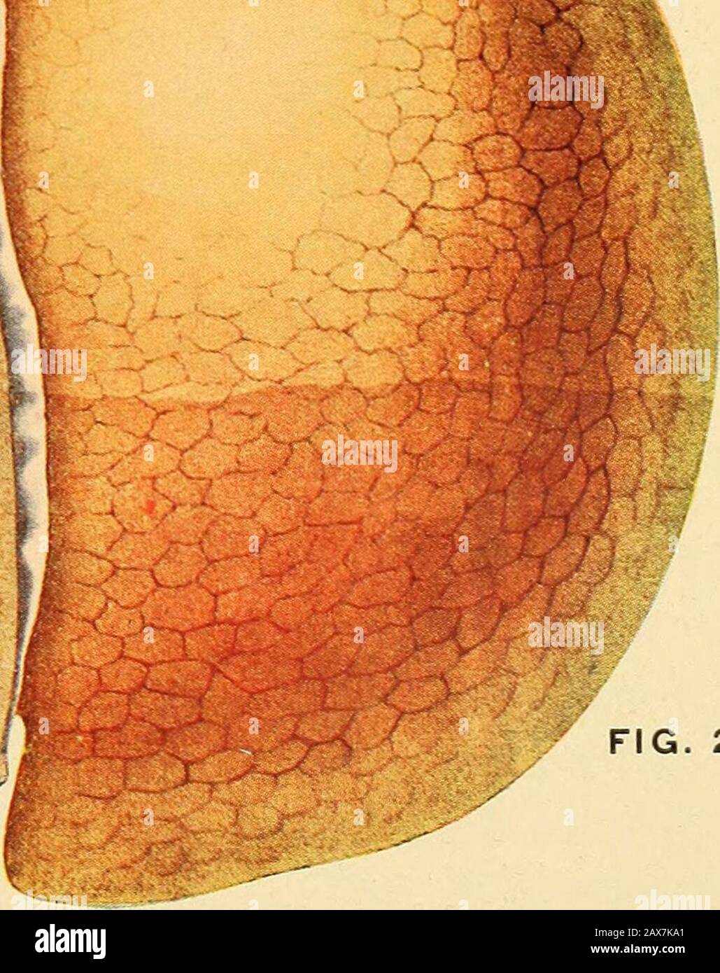 Skin contracted hi-res stock photography and images - Alamy