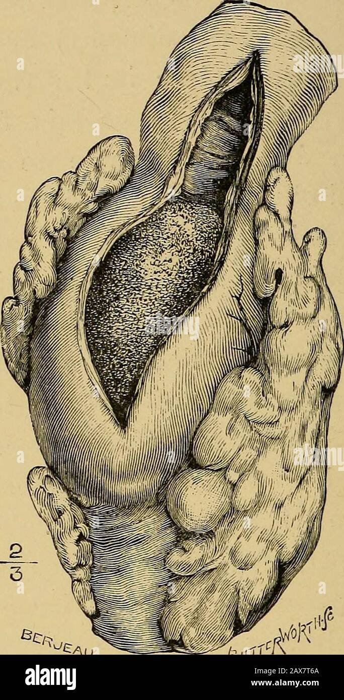 Bowel perforation hi-res stock photography and images - Alamy