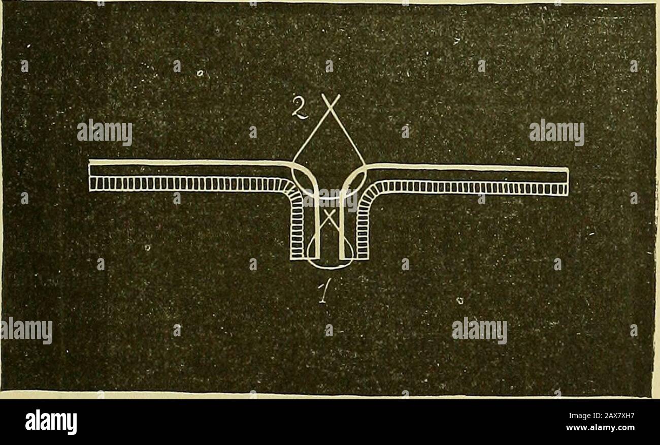 Exercises in equine surgery . Fig. 35.—Gelys Suture. 4.—Czernys Suture ...