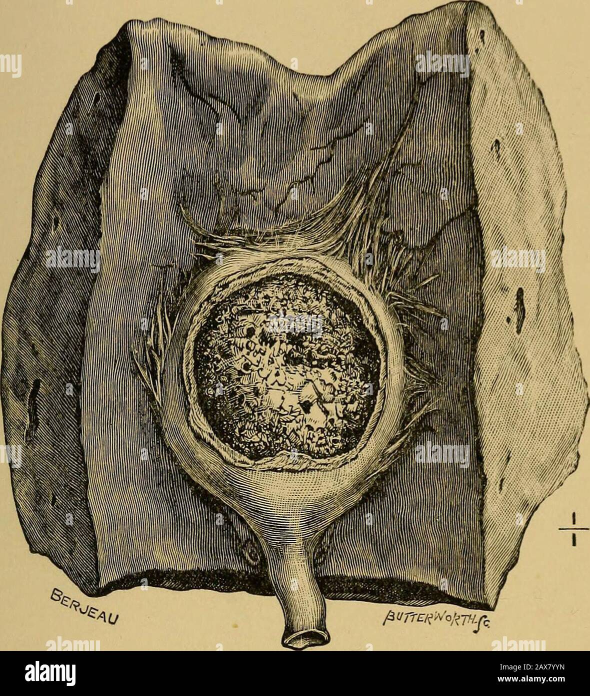 Gall-stones and diseases of the bile-ducts . g hydrops may appro ...