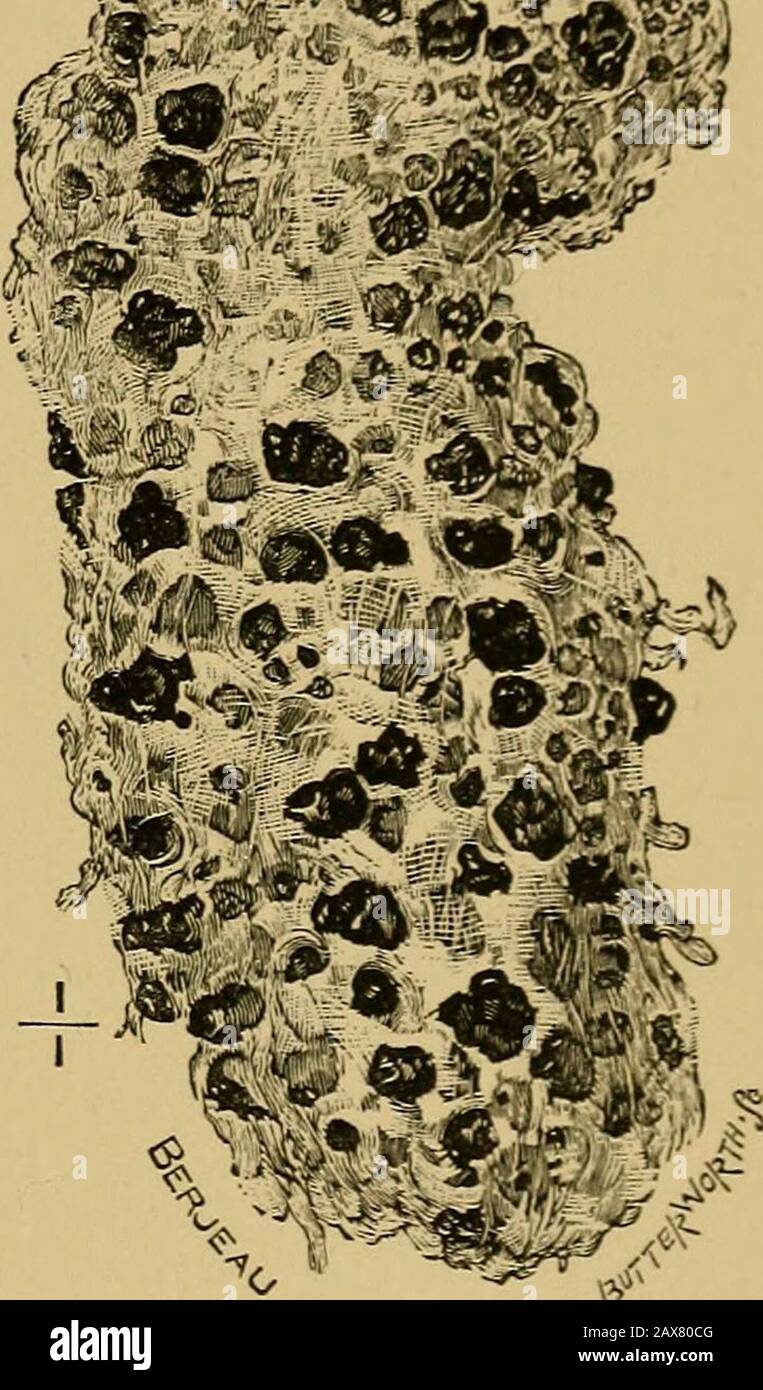 Gall-stones and diseases of the bile-ducts . Hi. Fig. 22.—A gall ...