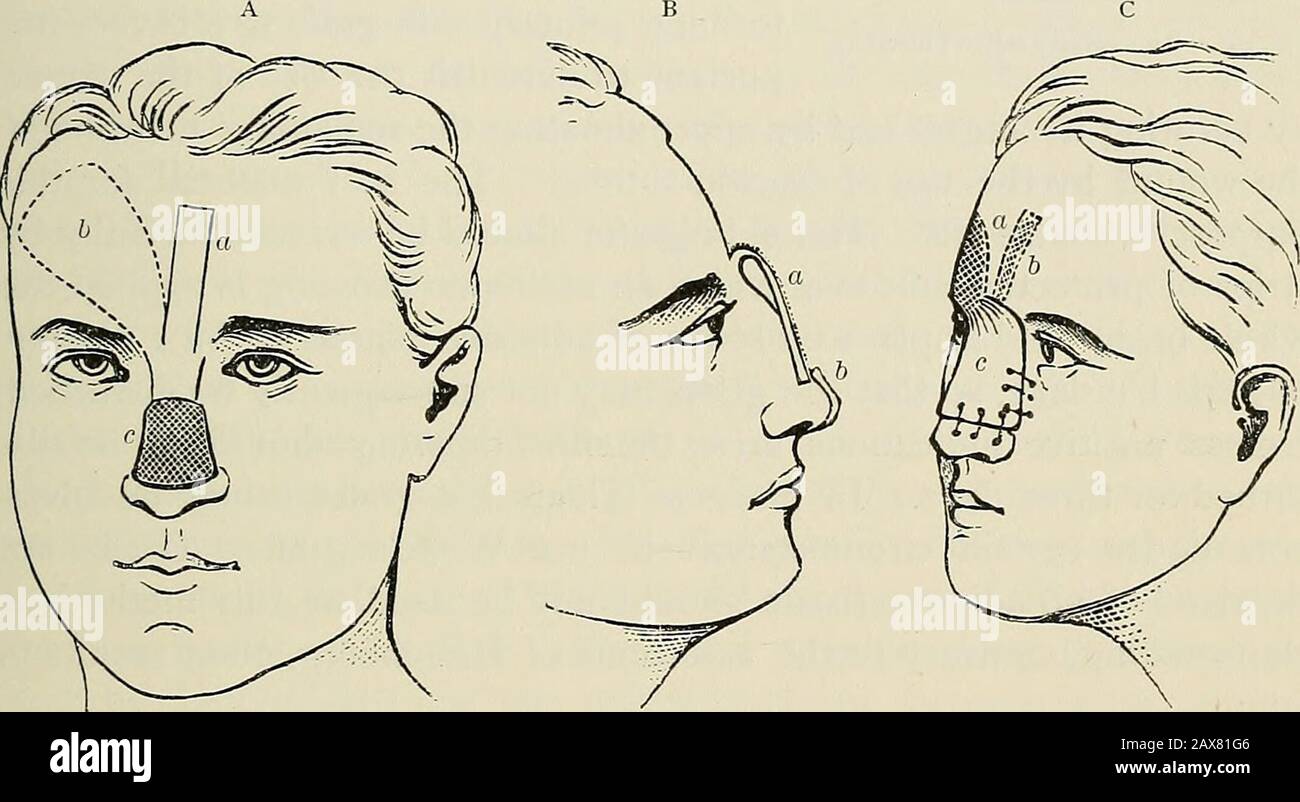 The pathology and surgical treatment of tumors . posite side of the ...
