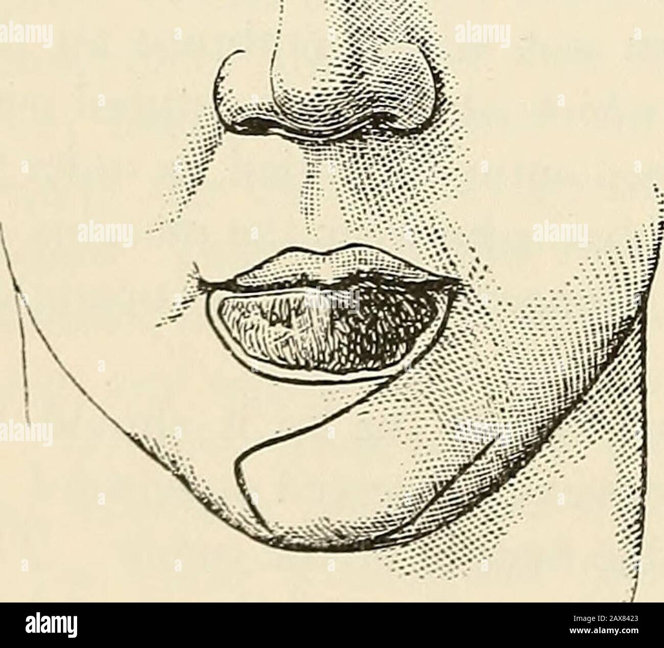 The pathology and surgical treatment of tumors . ound is sutured sepa ...