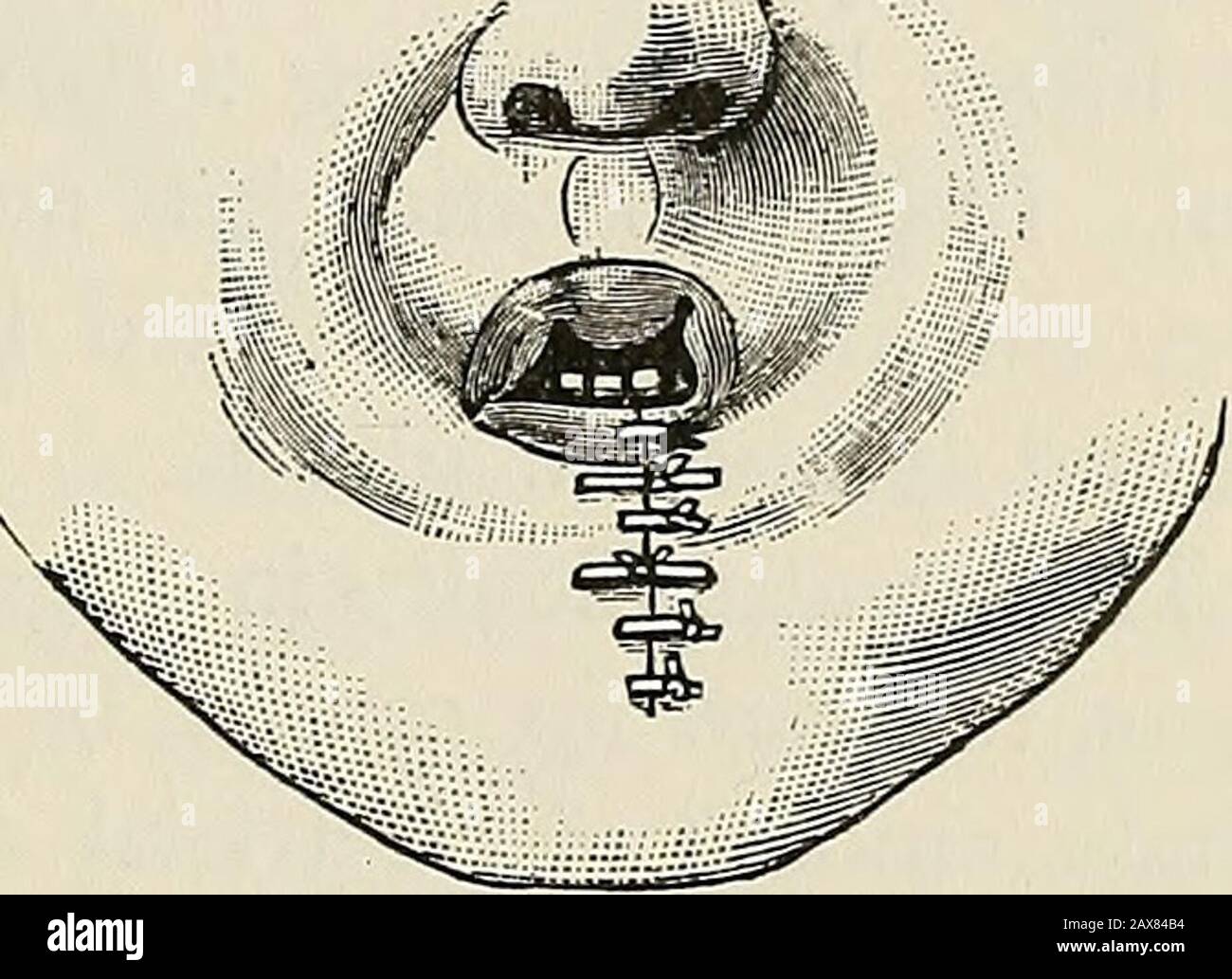 The pathology and surgical treatment of tumors . Fig. 157.—Wedge-shaped ...