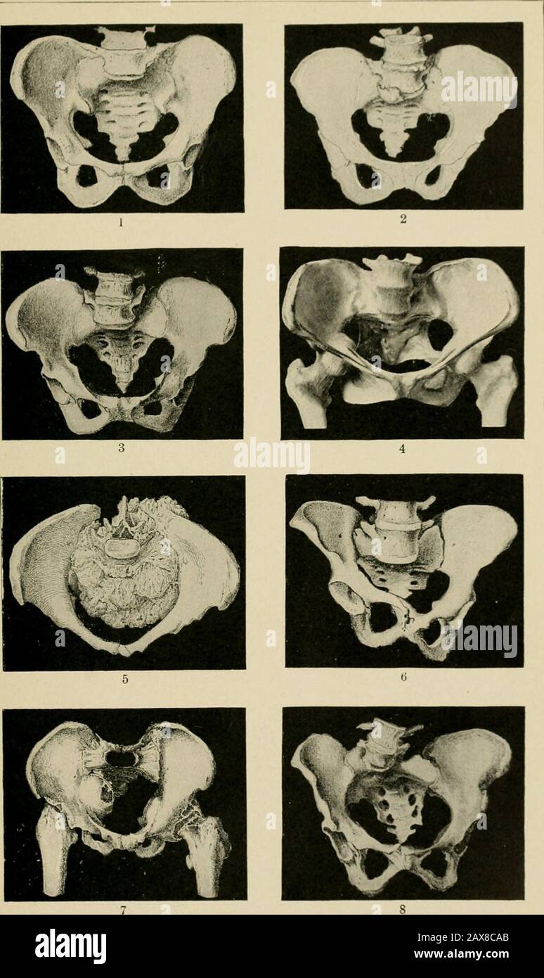 Triradiate Pelvis Osteomalacia