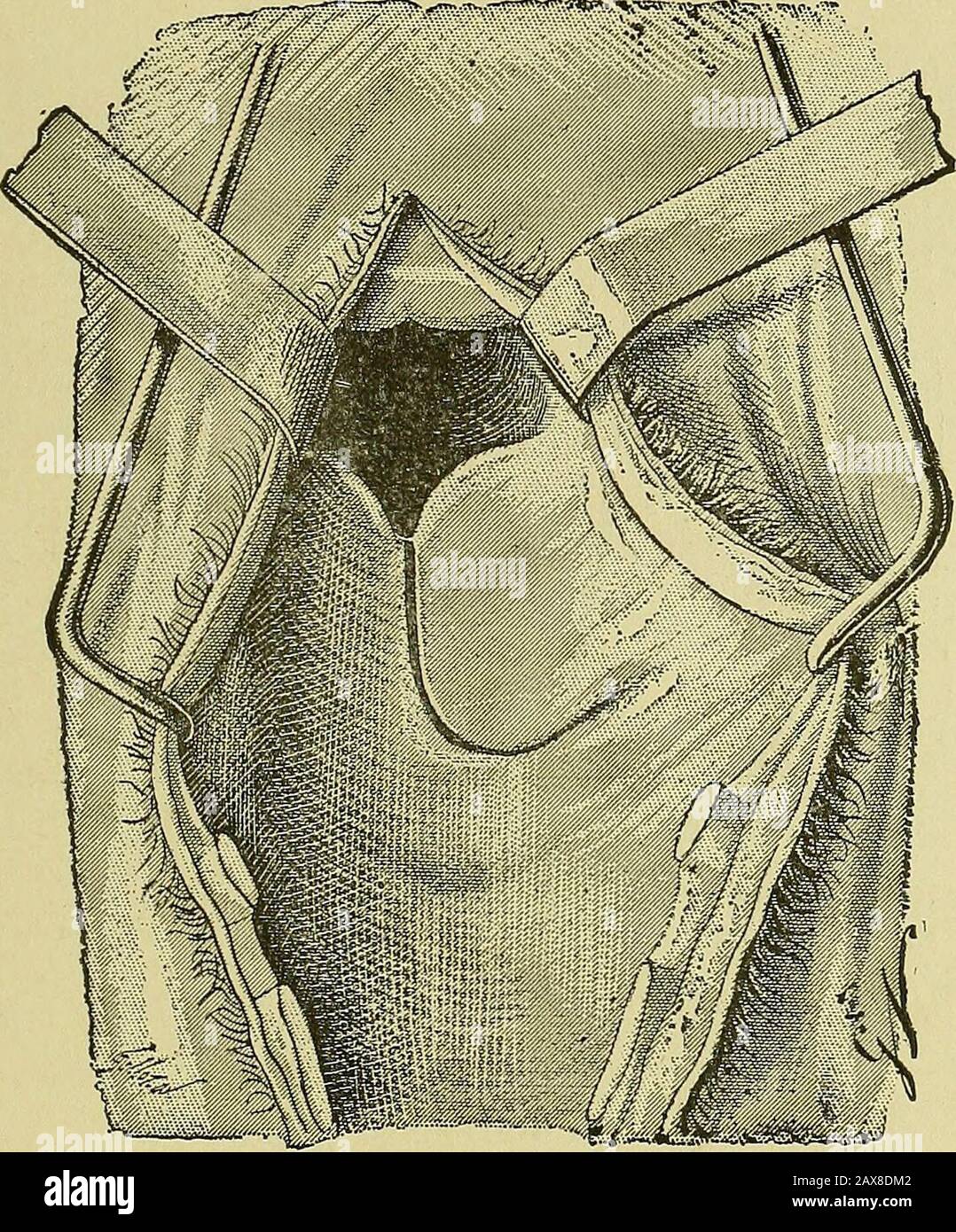 Exercises in equine surgery . Fig. 14.—Arytenectomy. The second step is ...